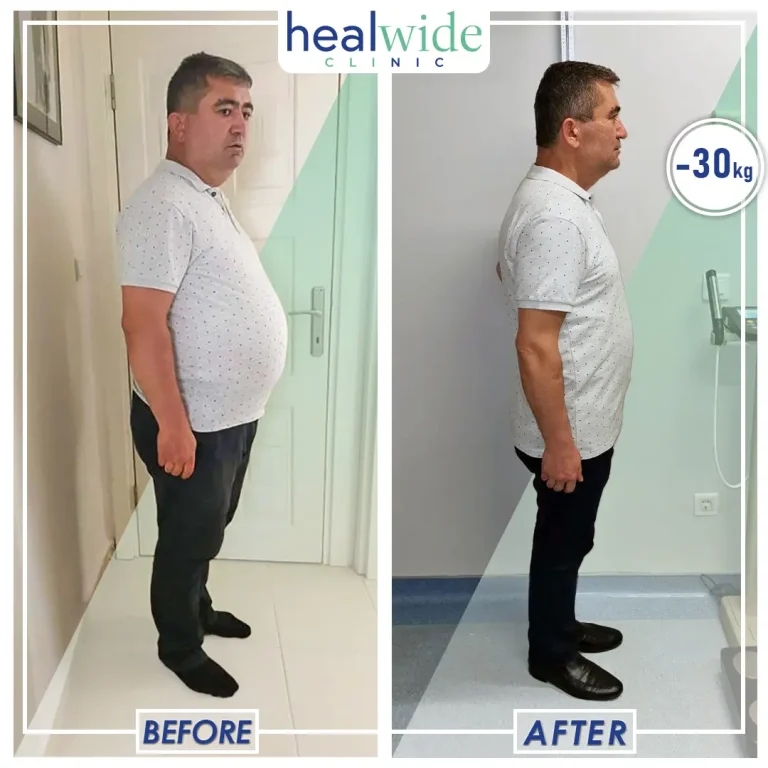 Bariatric Surgery Before and After Photos - Healwide