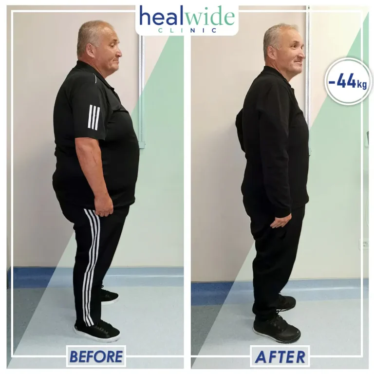 Bariatric Surgery Before and After Photos - Healwide