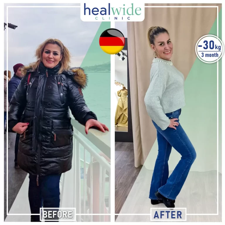 Bariatric Surgery Before and After Photos - Healwide